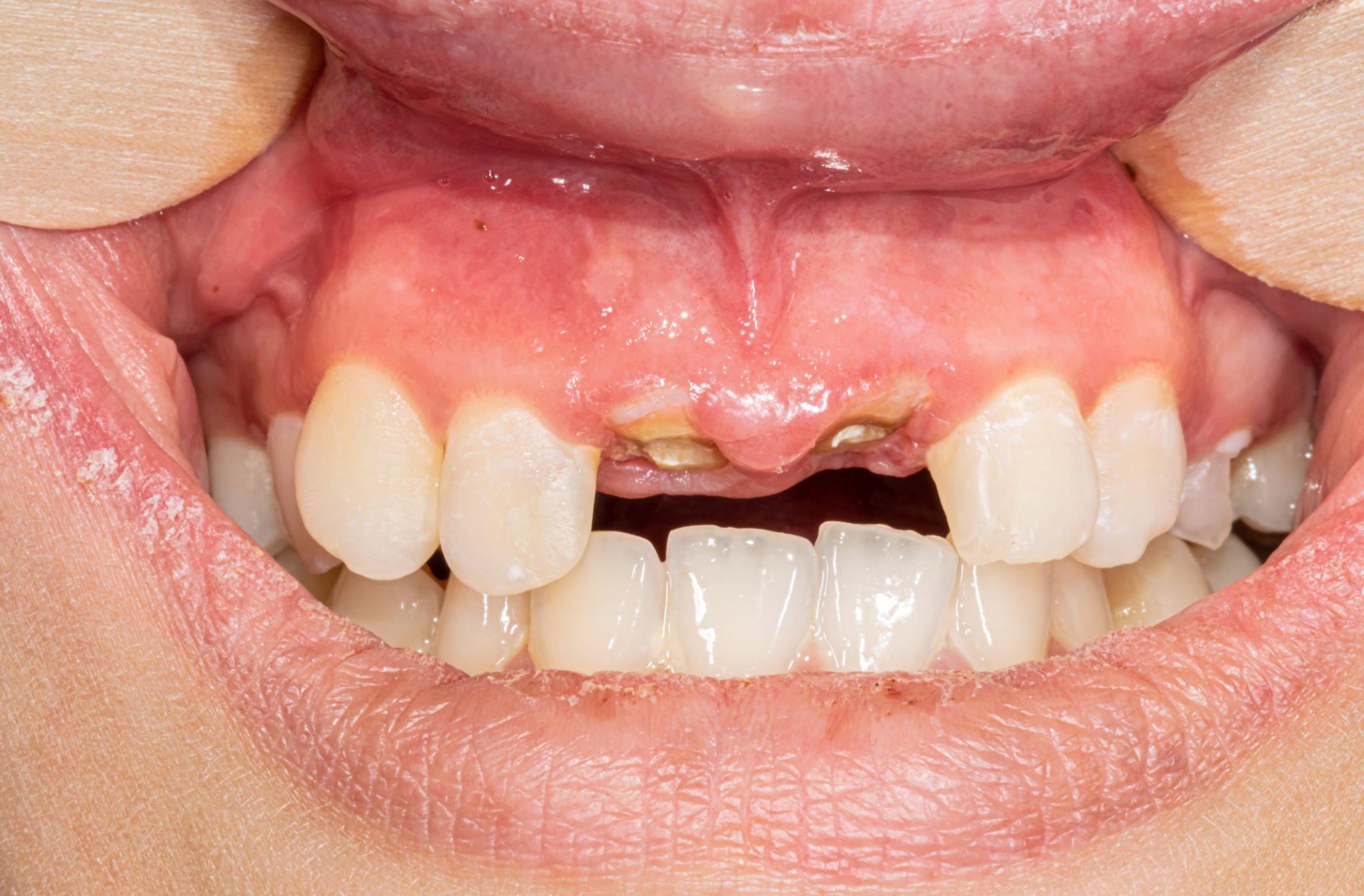 Dealing with Dental Implant Failures January 2025 - Esthetica Dealing with Dental Implant Failures January 2025 - Esthetica